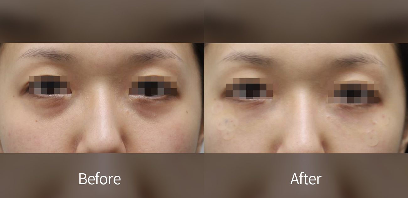 C-Line Lifting Filler – Gangnam HERA | seoul | korea | filler | Lifting